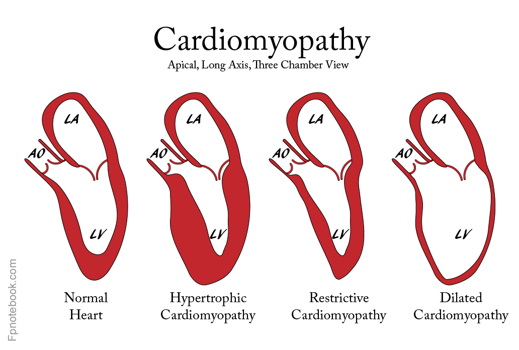  Cardiomyopathy 