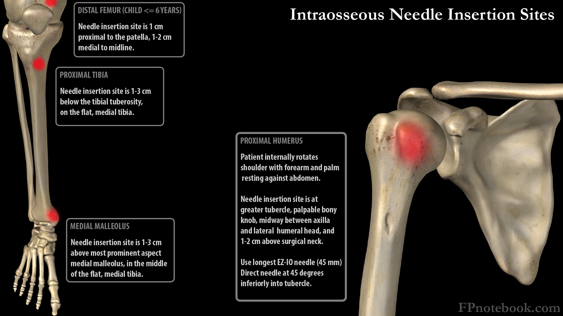 Intraosseous Access