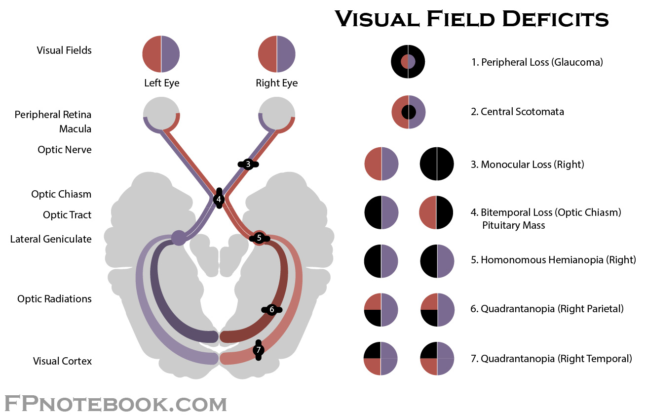 Visual Field Deficit
